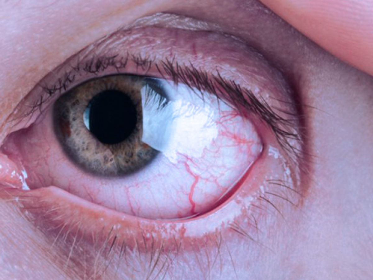 Olho De Gato Toxoplasmose Toxoplasmose Ocular Adquirida Blog Da