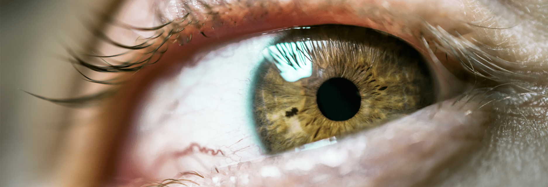 Melanoma ocular: o que e, como diagnosticar e muito mais | Lenscope