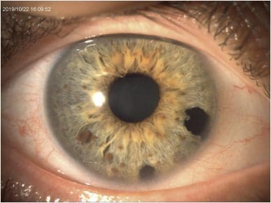 Policoria (duas pupilas em um olho): tudo sobre essa condição rara ...