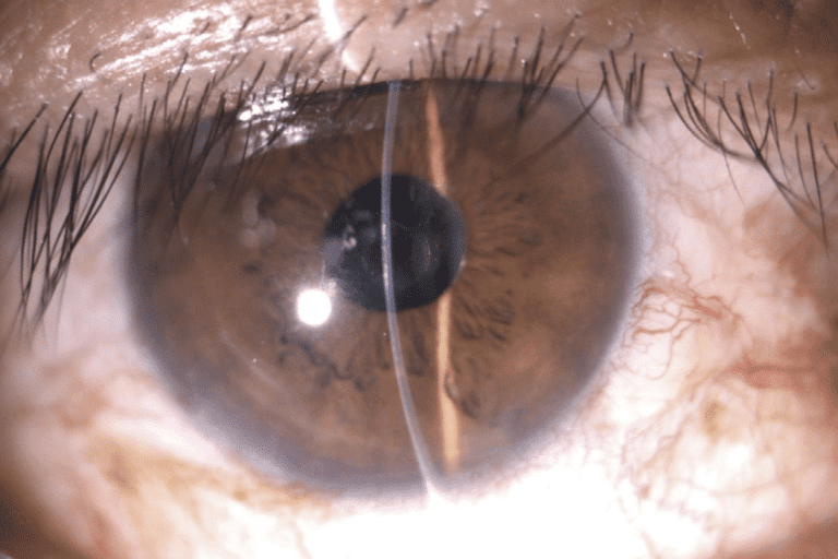 Cicatriz no olho tem cura? Causas, sintomas e tratamentos | Lenscope