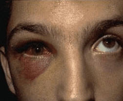 Principais tipos de lesões oculares, como tratar e prevenção | Lenscope